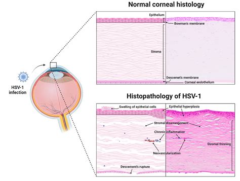 Inflammation Suppressing Cornea In A Syringe With Anti Viral Gf19 Peptide Promotes Regeneration