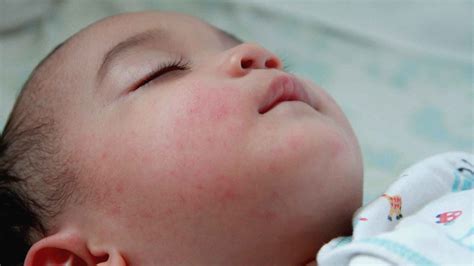 Apa Itu Dermatitis Penyebab Dan Cara Mengatasi Sensicare