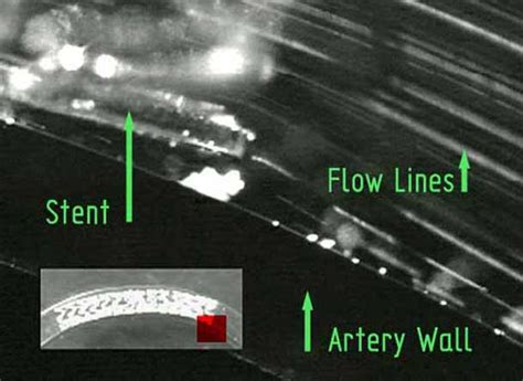 Pulsatile Flow Through An Arterial Stent Flometrics