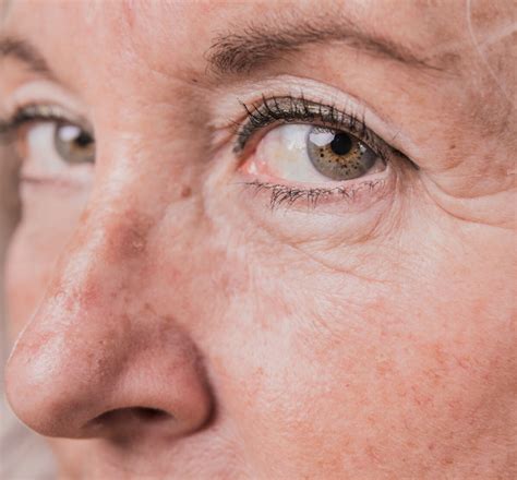 Botox For Droopy Eyelids In Bellevue And Kirkland Wa