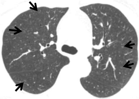 Interstitial Lung Abnormalities At Ct Subtypes Clinical Significance