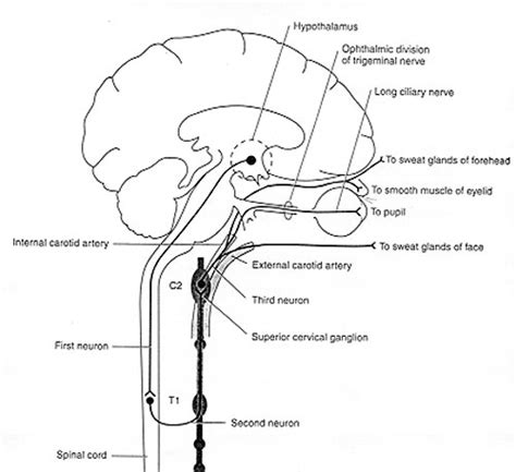 Neuro Ophthalmology Questions Of The Week Horner Syndrome