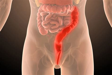 Is Ulcerative Colitis An Autoimmune Disease