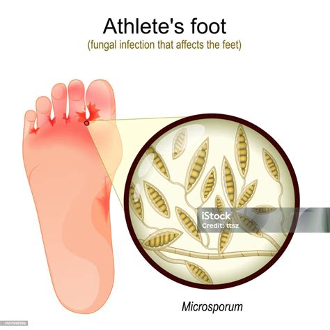 Athletes Foot Fungal Infection That Affects The Feet Stock Illustration