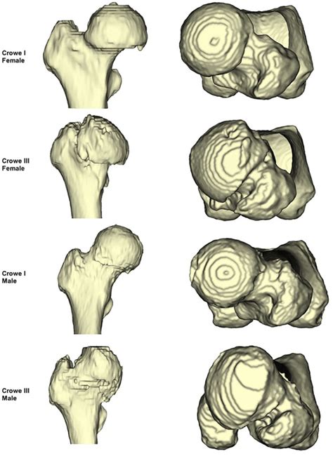 Gender And Disease Severity Determine Proximal Femoral Morphology In
