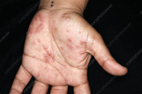 Pustular Palmoplantar Psoriasis Stock Image C0602562 Science Photo Library
