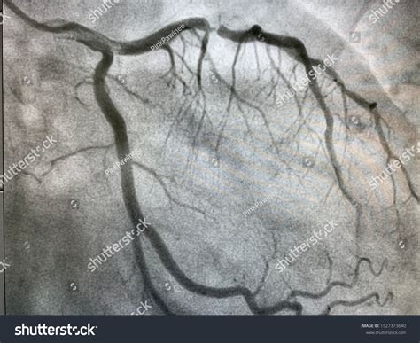 Left Coronary Artery Angiogram
