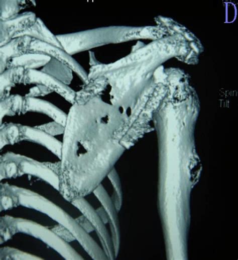 A 3 D Computed Tomography Reconstruction Taken 14 Months After The