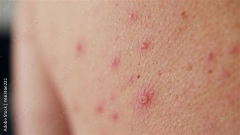 Close Up Of Chicken Pox On The Back Of An Adult Person The Classic Symptom Of Chickenpox Is A