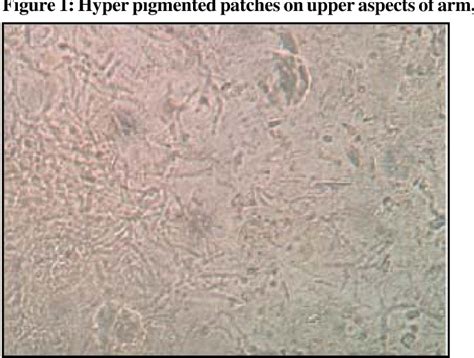 Tinea Versicolor Koh Findings At Kayla Olney Blog