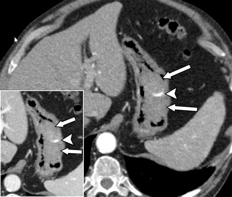 Ct Scan Gi Tract At Ginny Richter Blog