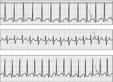 Electrocardiographic Differential Diagnosis Of Narrow Complex