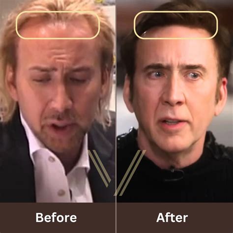 Nicolas Cage Hair Transplant Before And After Transformation