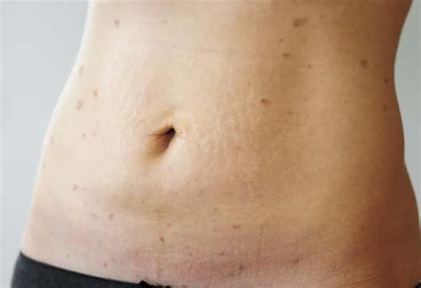 What Is Lichen Planus Symptoms Causes Treatment Medical Journey