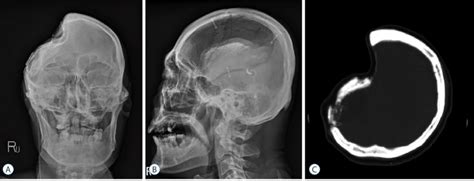 Plain Skull X Ray Anteroposterior A Lateral View B And Computed