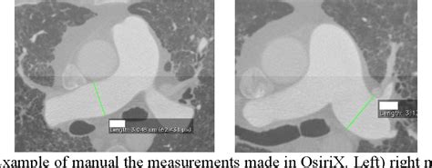 figure 1 from a semi automated quantification of pulmonary artery