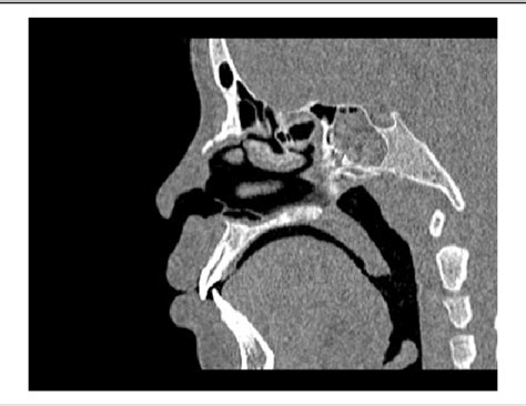 Sphenoid Sinus Polyp Semantic Scholar