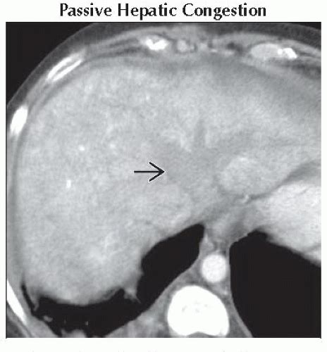 Da9 Db1 Mosaicorpatchyhepatogram Ffu1 Abdominal Key