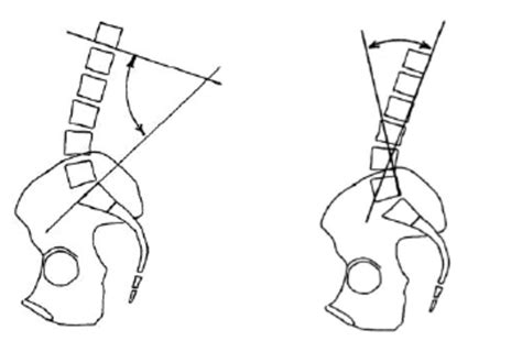The Cobb Left And Tangent Right Methods For Measuring Lumbar Angle Download Scientific