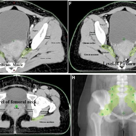 Characteristics Of Patients With Radiation Induced Lumbosacral