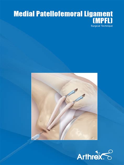 Medial Patellofemoral Ligament Mpfl Download Free Pdf Knee Lower Limb Anatomy