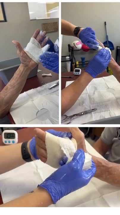 How Serial Casting Helps With Stiff Pip Joints Hand Therapy Academy