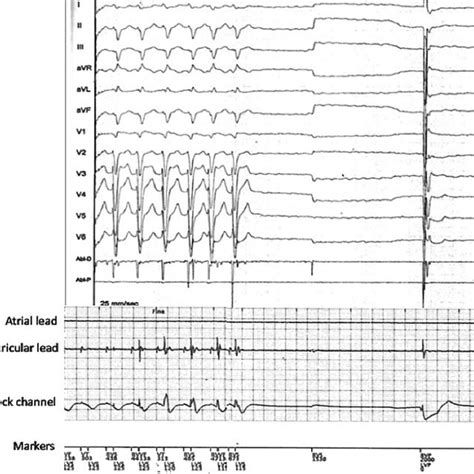 A Ecg Showing Two Ventricular Beats After One Atrial Beat ∗