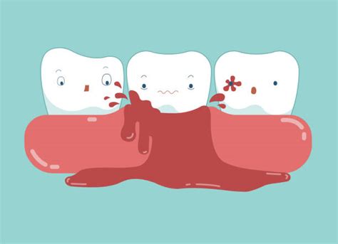 Gingivitis Pictures Illustrations Royalty Free Vector Graphics And Clip