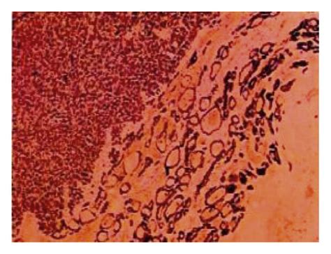 Pathological Classification Of Thyroid Cancer Download Scientific Diagram