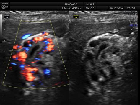 Gall Bladder Varices Looking Through A Transducer