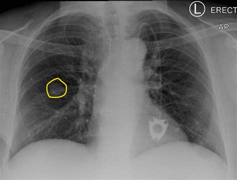 What Are Nodules On Chest X Ray At Zane Stirling Blog