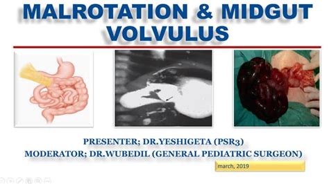 Malrotation And Midgut Volvulus Finalpdf