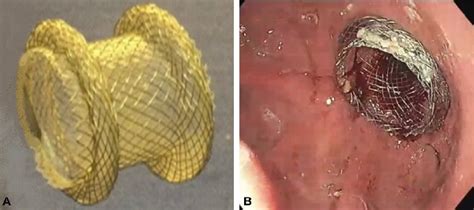 Endoscopic Management Of Stomal Stenosis