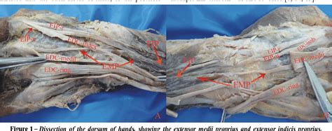 Extensor Indicis Cadaver