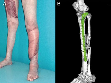 Case Open Fracture Of The Left Tibia In A Year Old Female A Download Scientific Diagram