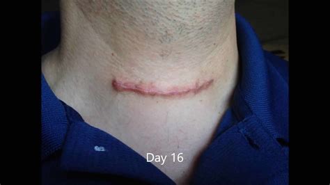 Thymectomy Complications At Chelsea Sommerlad Blog