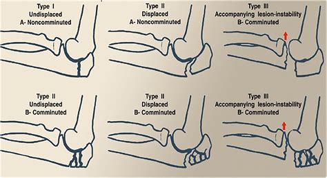 Olecranon Fractures An Old Fixation Device For A New Surgical Technique Injury Olecranon Fractures An Old Fixation Device For A New Surgical Technique Injury
