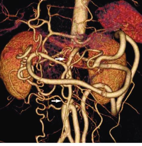 Computed Tomographic Angiography Showed An Abrupt Segmental Occlusion