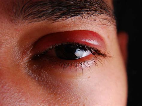 Eye Infection Cellulitis At Larry Cyr Blog