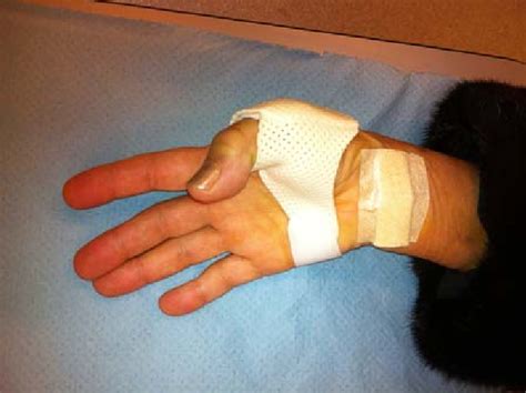 Removable Splint Of The Thumb Download Scientific Diagram