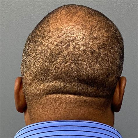 Plastic Surgery Case Study Custom Skull Implant For Lop Sided Head