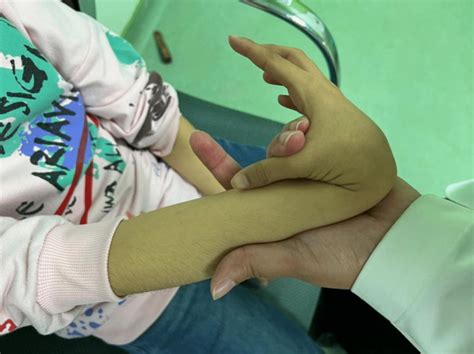 A Novel De Novo Mutation Of The Dhx30 Gene In A Patient With