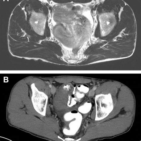 Endoscopy Images Shown Are A The Mass In The Appendix And The