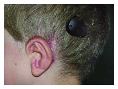 Young Patient With Grade Iii Microtia And Aural Atresia After Auricular