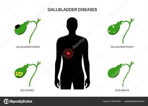 Gallbladder Diseases Infographic Gallstone Cancer Acute Cholecystitis Psc Polyps Digestive Stock