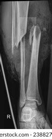 Xray Image Broken Tibia Fibula Stock Photo 2388274217 Shutterstock