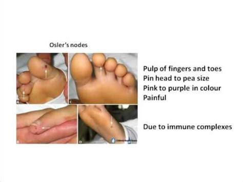 Oslers Nodes And Janeway Lesions Youtube