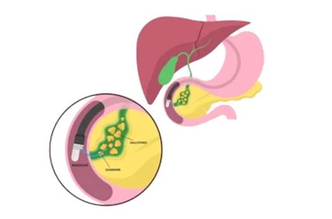 Advanced Ercp Procedures Dynamic Liver