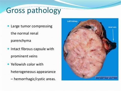 Wilms Tumor