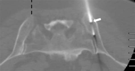 Ct Guided Bone Marrow Biopsies Cost 13 Times More Than Non Image Guided